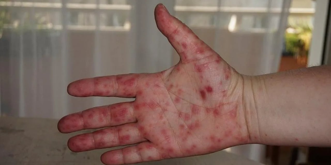 Virus de coxsackie: ¿Cómo se contagia, cuáles son los síntomas y cómo ...